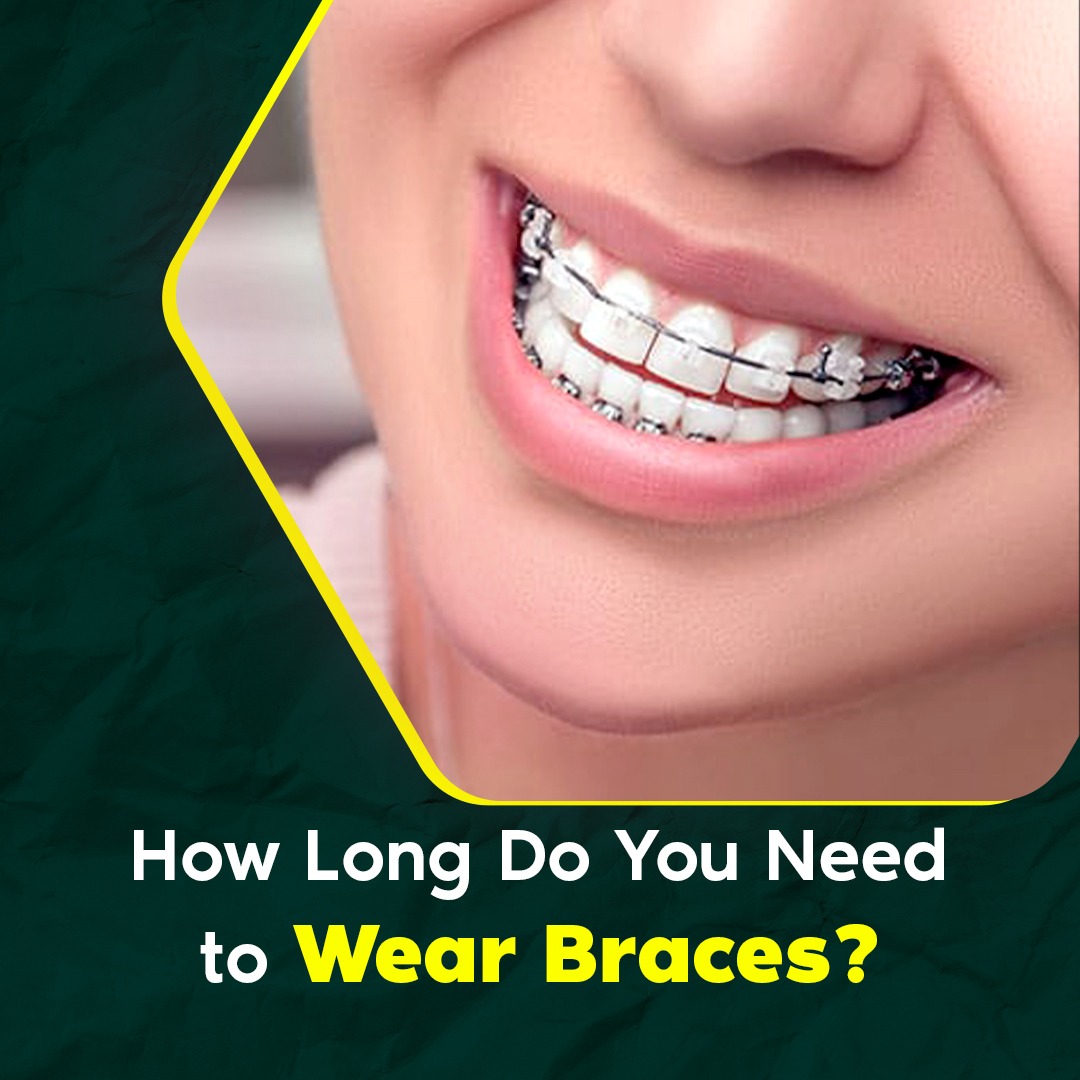 How Long Will You Need Braces?