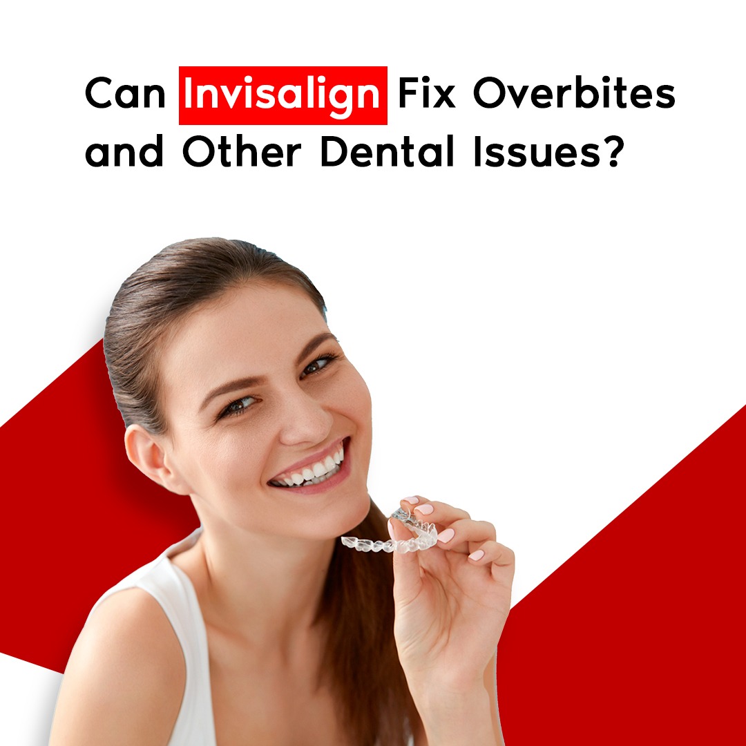 Can Invisalign Fix Overbites and Other Dental Issues? | Risus Dental ...
