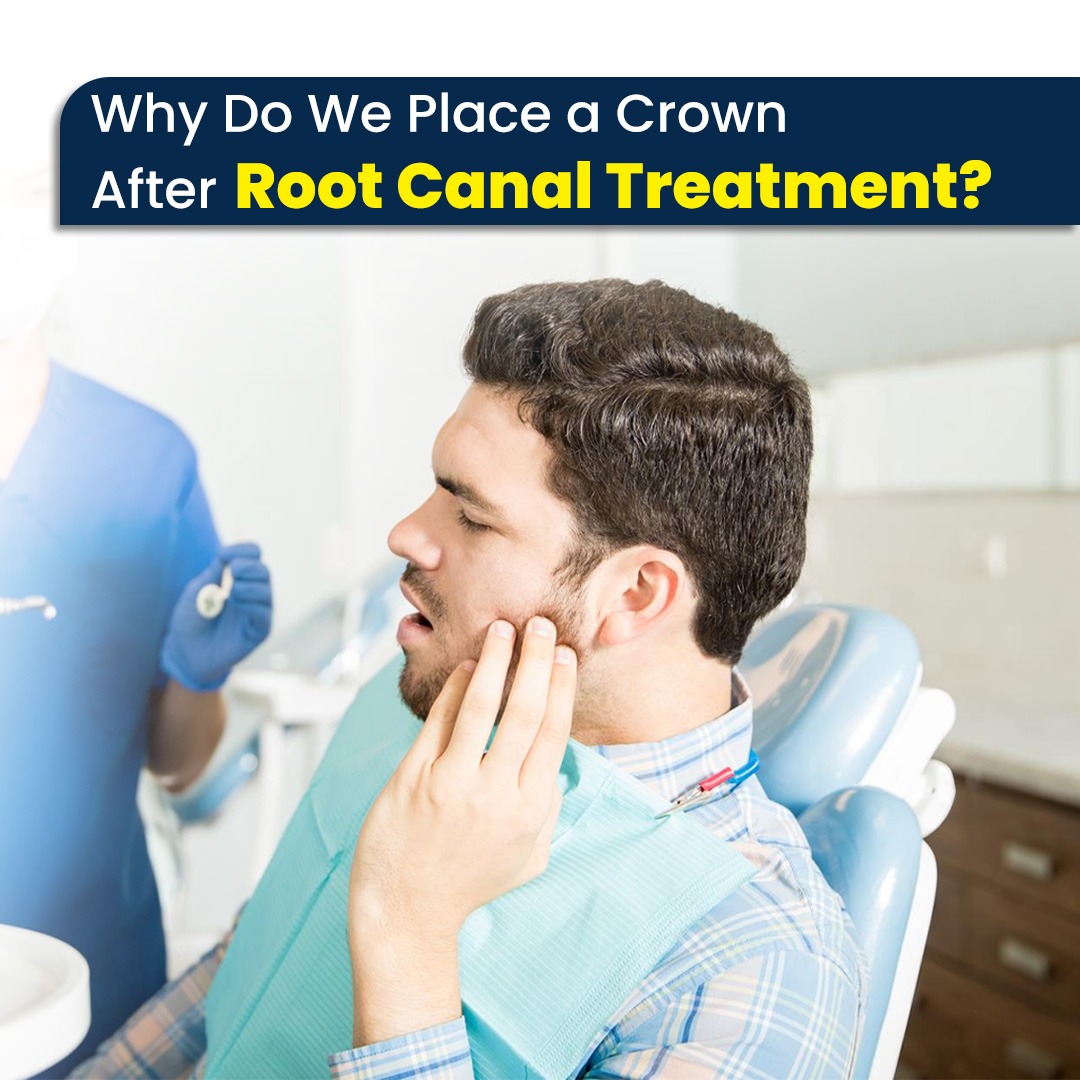 Why Do We Place a Crown After Root Canal Treatment? - Risus Dental Clinic