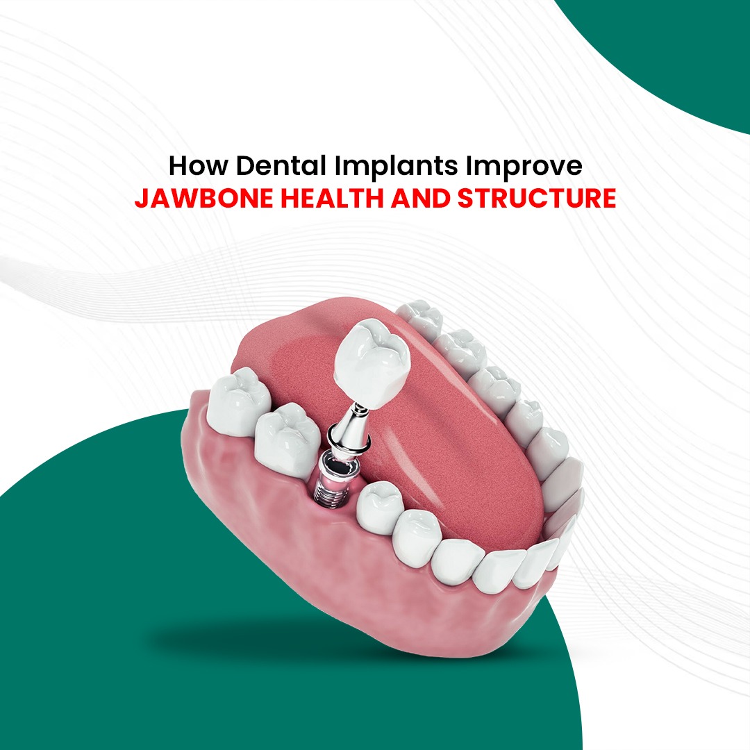 How Dental Implants Improve Jawbone Health and Structure