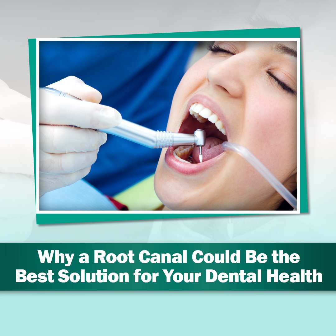 Why a Root Canal Could Be the Best Solution for Your Dental Health ...
