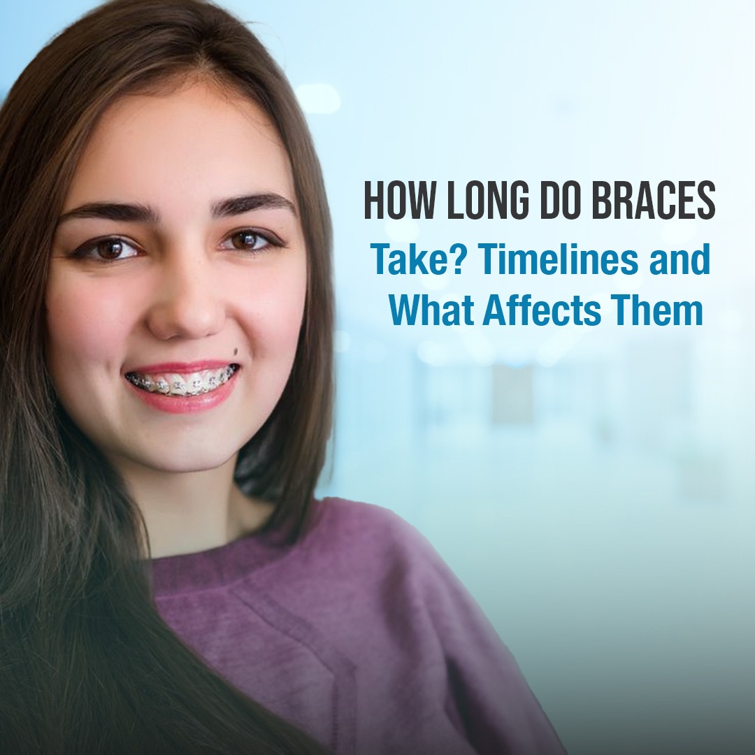 How Long Do Braces Take? Timelines and Influencing Factors Explained