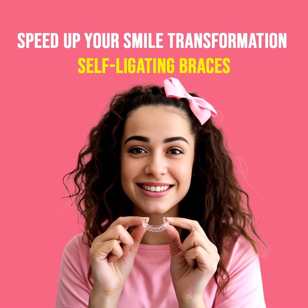 Speed Up Your Smile Transformation with Self-Ligating Braces - Risus ...